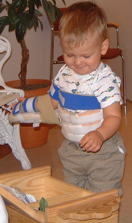 axelortos 1,5 år | Plexusskada